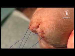 The Malone meatoplasty: A dorsal approach to meatal stenosis in patients with lichen sclerosus