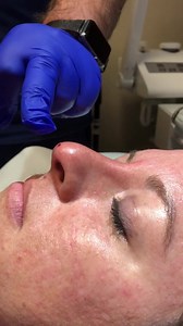 Nose job an office based quick procedure with PDO Thread lift. The effect lasts 18-24 months. Dr. Sara is Board Certified in Aesthetic Medicine who was the first to introduce PDO Threads into Lexington area. Call 859-554-0519 for an appointment. | Advanced Skin & Vein Care Centers
