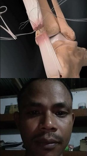 A step-by-step visualization of Achilles tendon reconstruction🩻✂️@maHealthCare