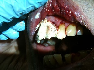 Infraorbital Nerve Block